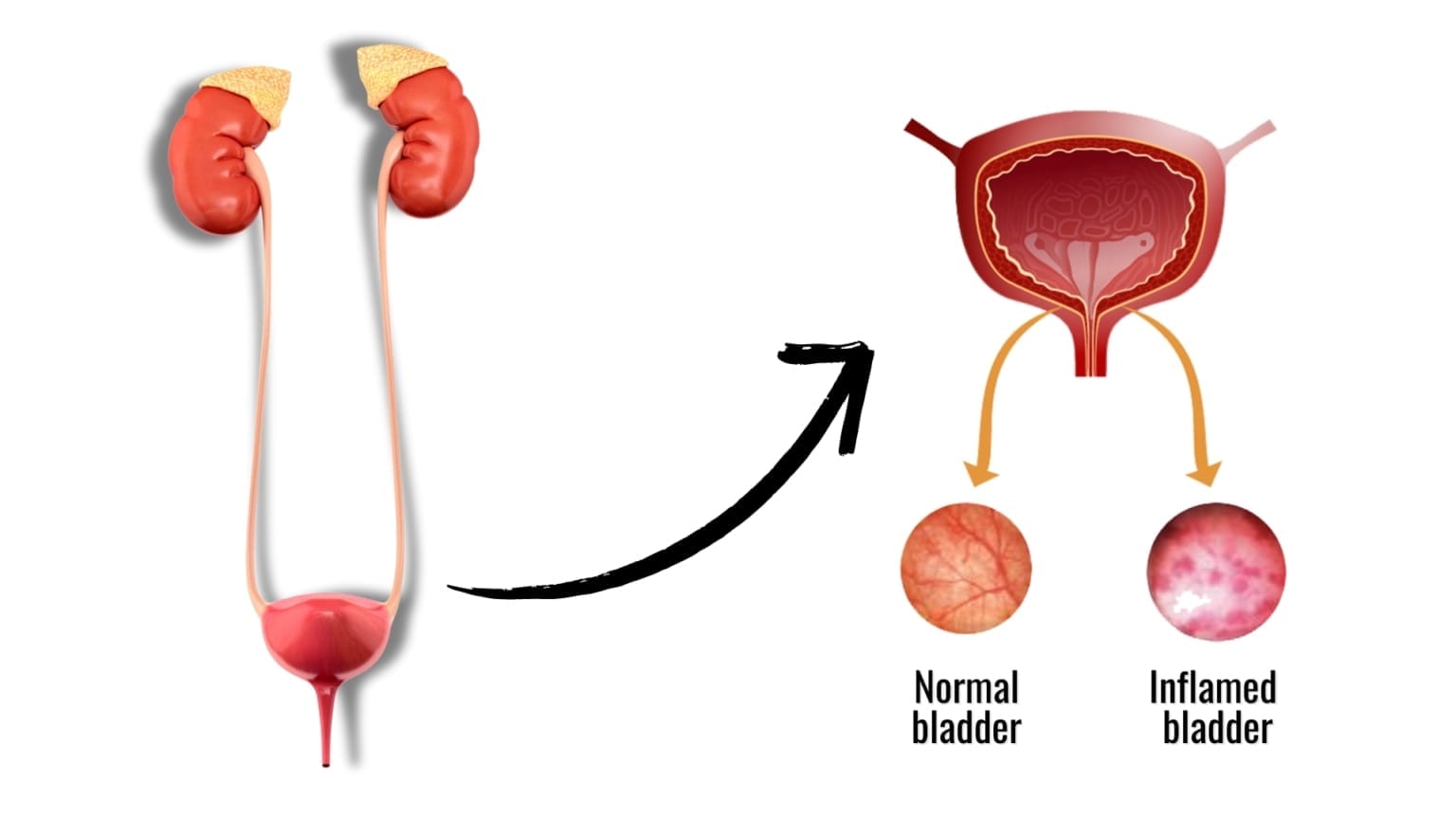 Bladder Inflammation: Comprehensive Guide with ANF Therapy®️
