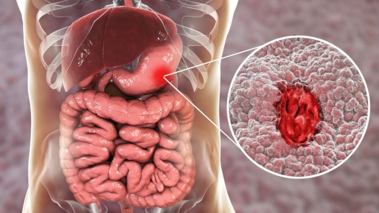 Inflammation of the Stomach: Causes, Symptoms, and Treatment - ANF Academy