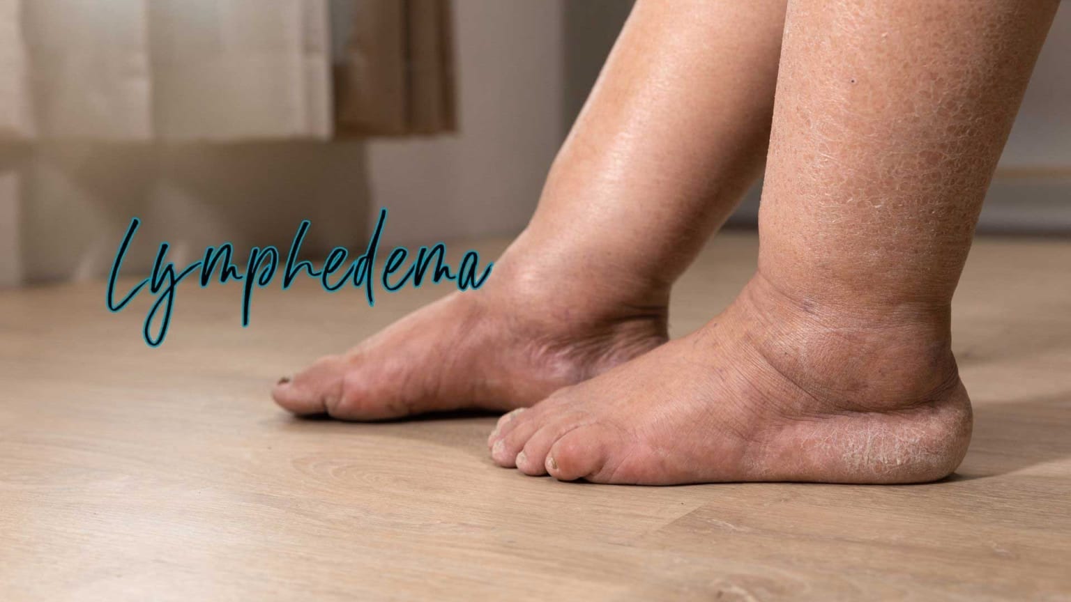 Lymphedema: A Detailed Guide To Advanced Treatment Approach