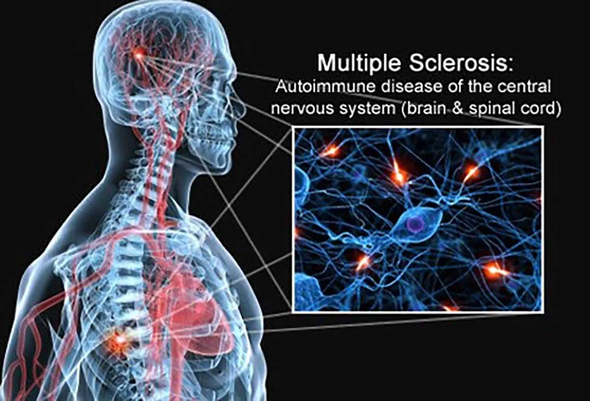 Multiple Sclerosis Autoimmune Diseases T20K Cyxone