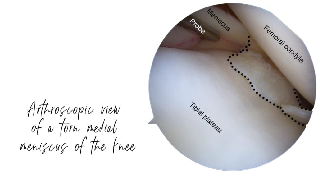 Torn Meniscus: Signs, Symptoms, and Advanced Treatment with ANF Therapy ...