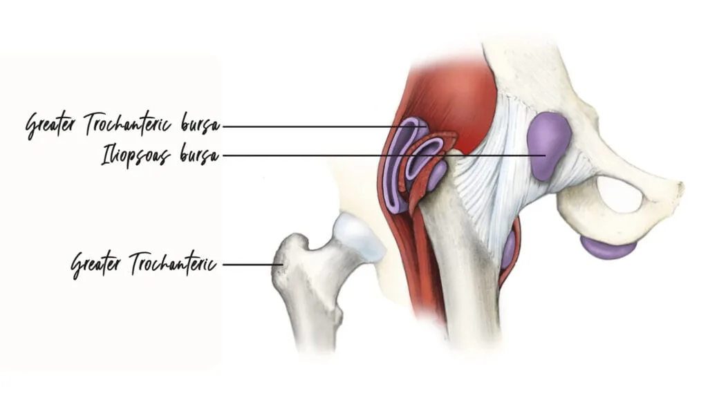 Trochanteric Bursitis Burst