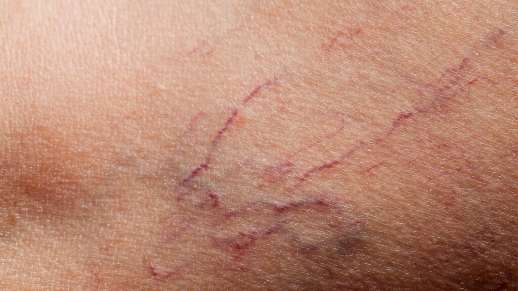 Varicose Veins: Symptoms, Causes and Advanced Treatment - ANF Academy