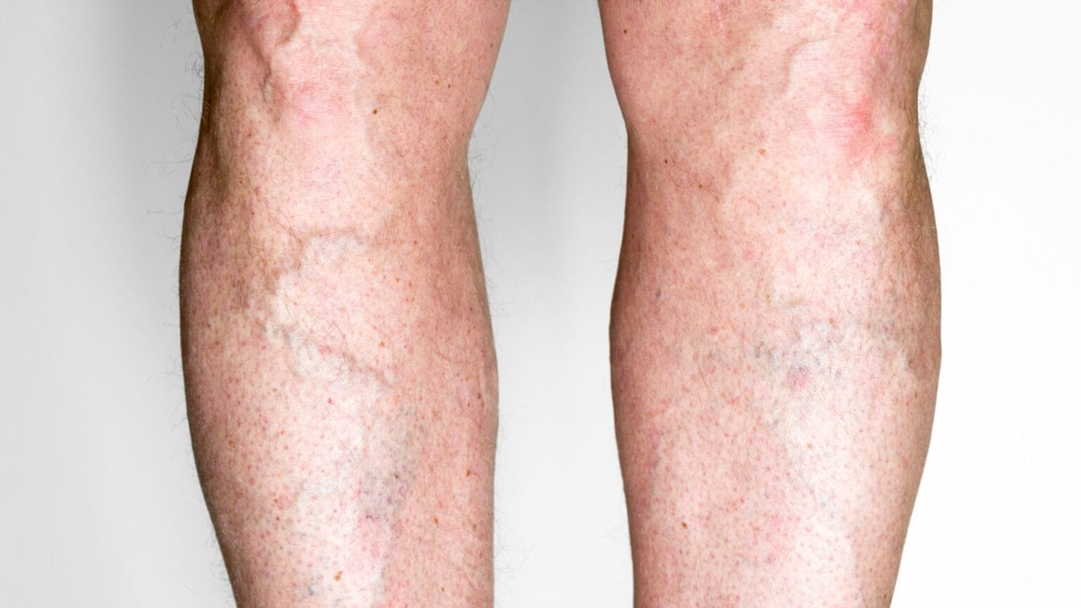 Varicose Veins: Symptoms, Causes and Advanced Treatment - ANF Academy
