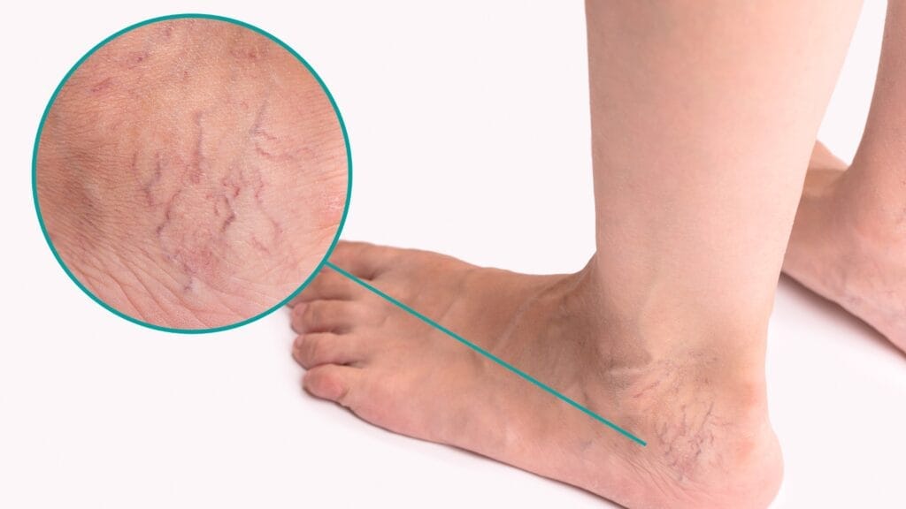 Varicose Veins: Symptoms, Causes and Advanced Treatment - ANF Academy