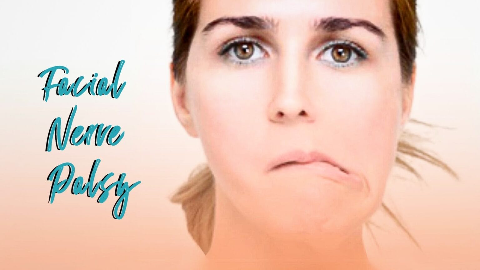 How to treat Facial Nerve palsy (Bell’s Palsy)? – ANF Academy