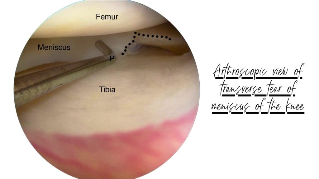 What happens if a meniscus tear is left untreated? – ANF Academy