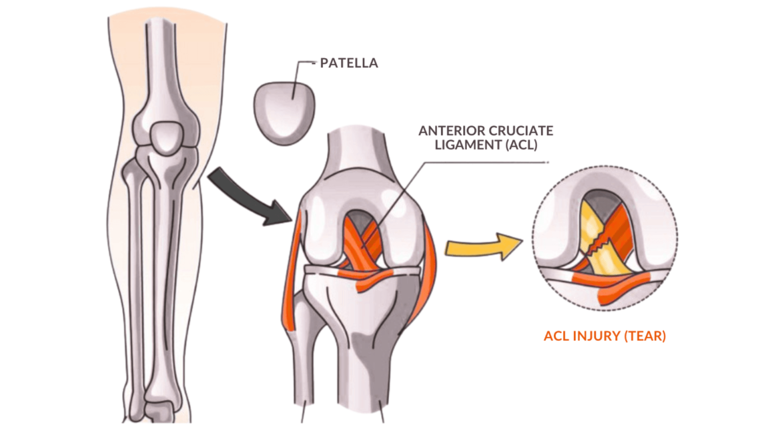 Can ACL injury heal without surgery? – ANF Academy